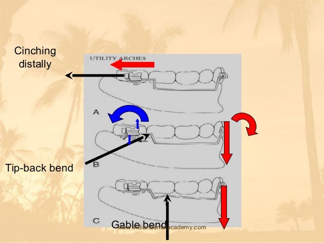Biomechanics of intrusion appliances final copy..