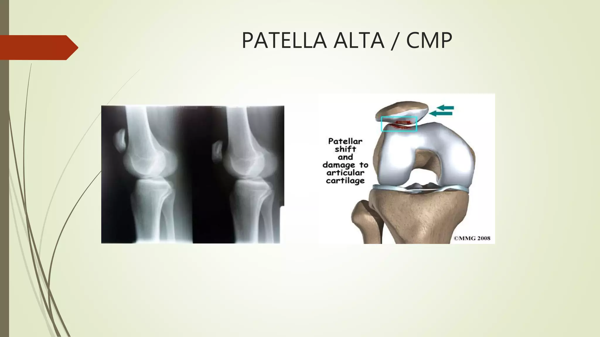 Biomechanics of knee | PPTX
