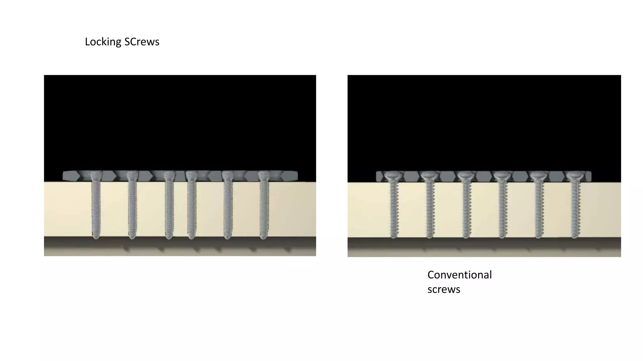 Biomechanics of locking plates | PDF