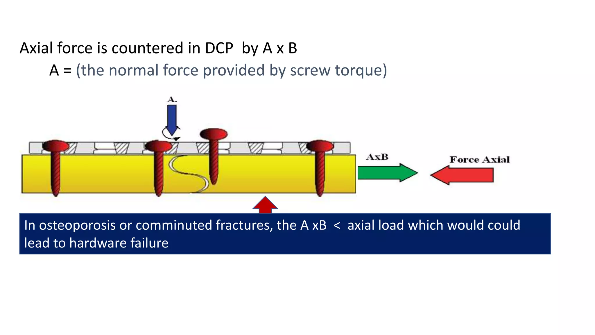 Biomechanics of locking plates | PDF