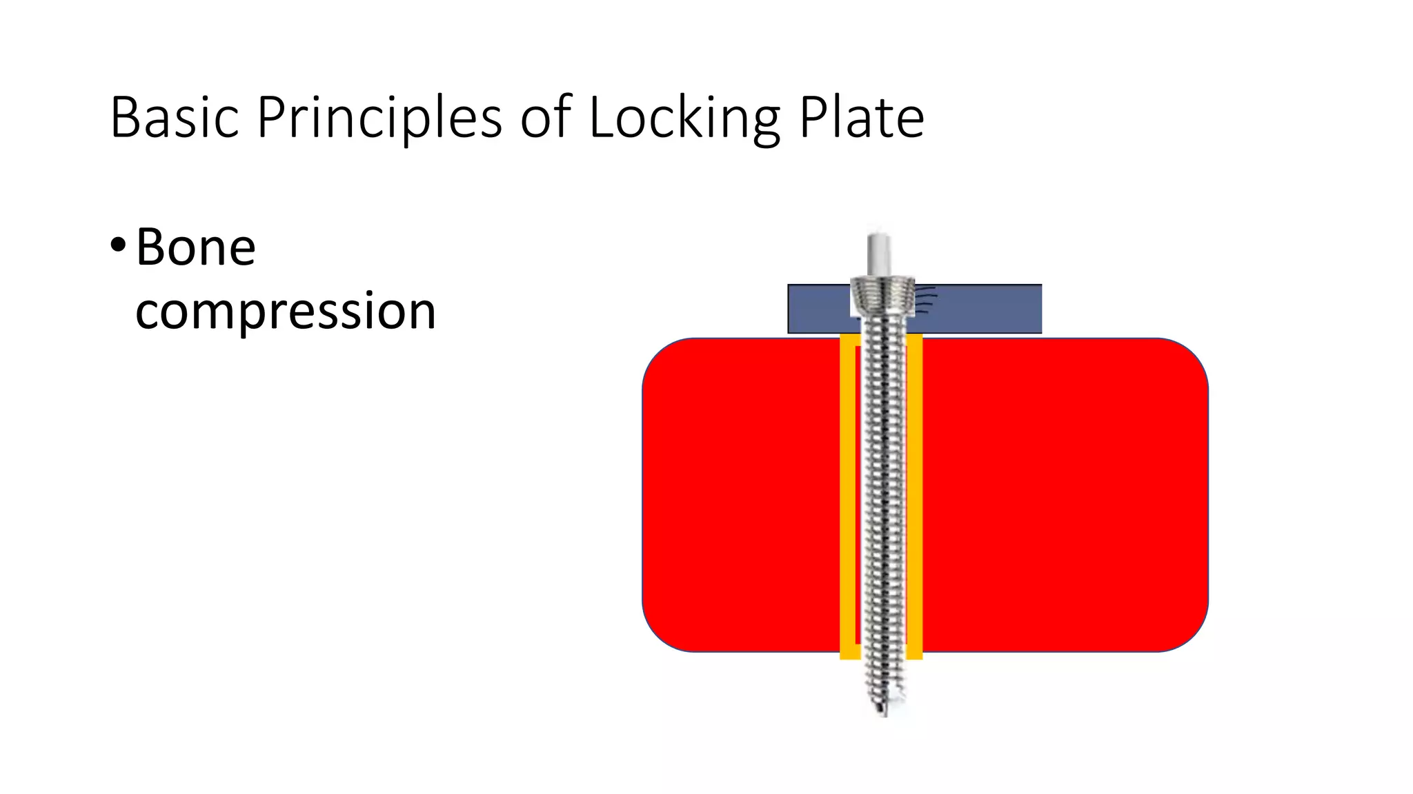 Biomechanics of locking plates | PDF