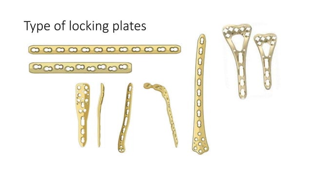 Biomechanics of locking plates | PDF