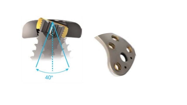 Biomechanics of locking plates | PDF