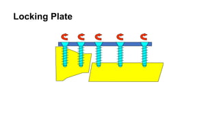 Biomechanics of locking plates | PDF
