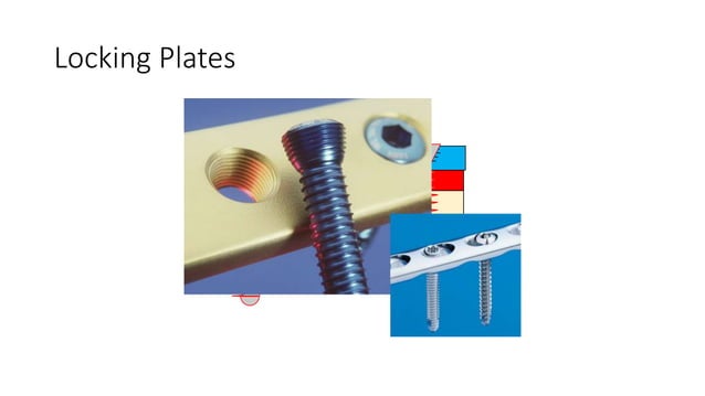 Biomechanics of locking plates | PDF