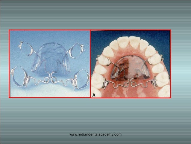 Biomechanics of molar distalization /certified fixed orthodontic cour…