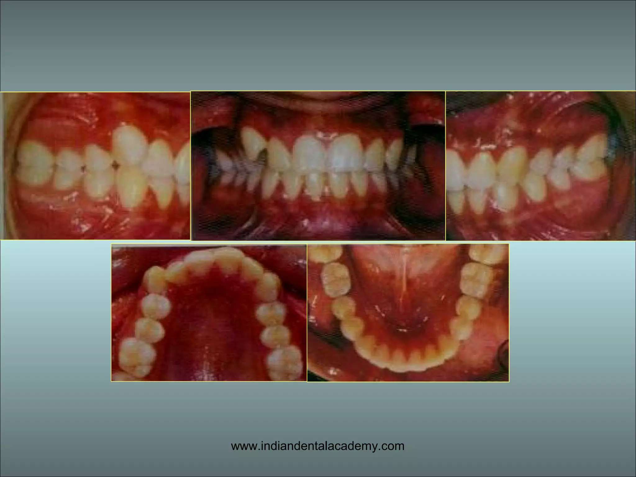 Biomechanics of molar distalization | PPT