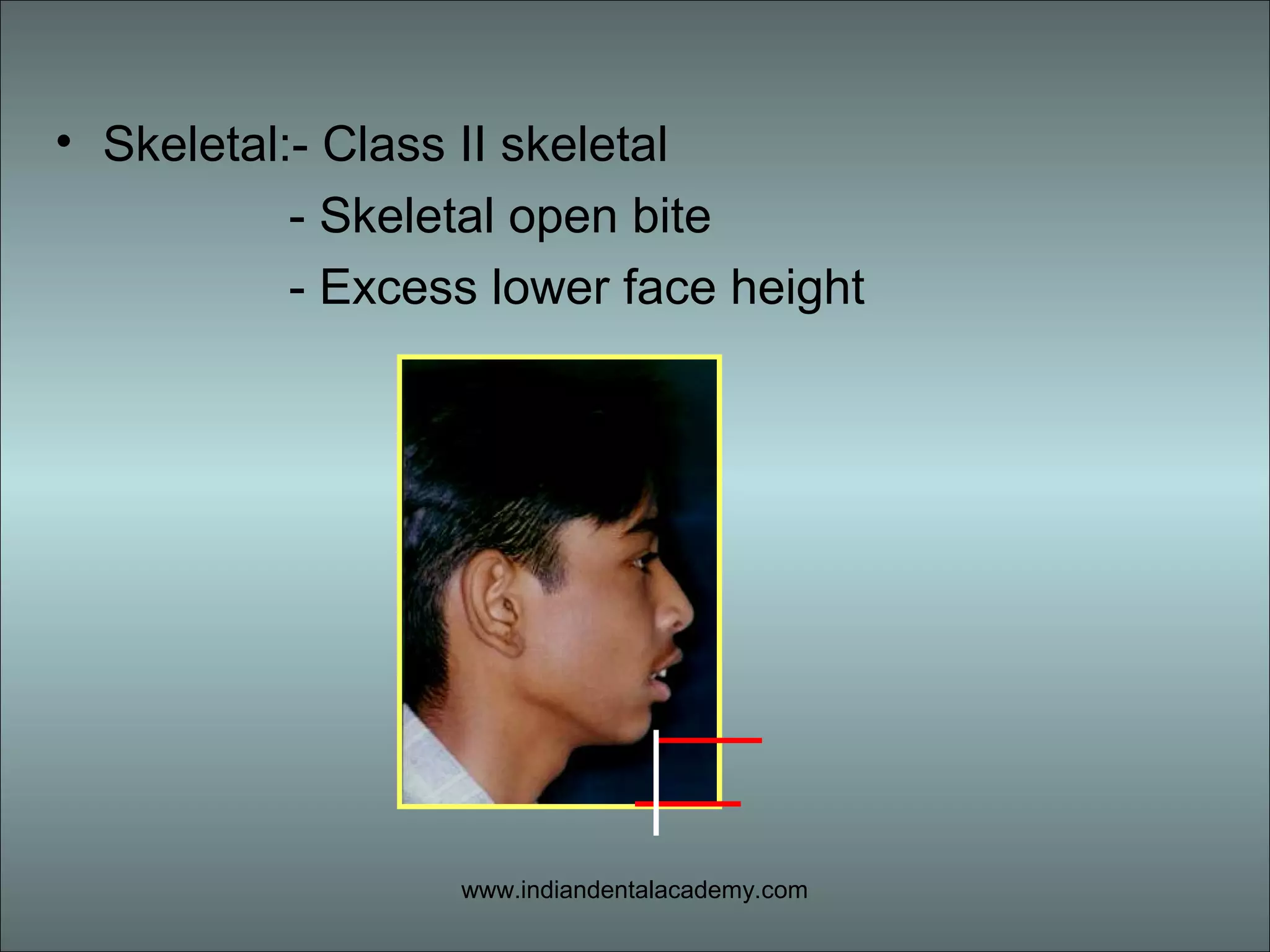 Biomechanics of molar distalization | PPT