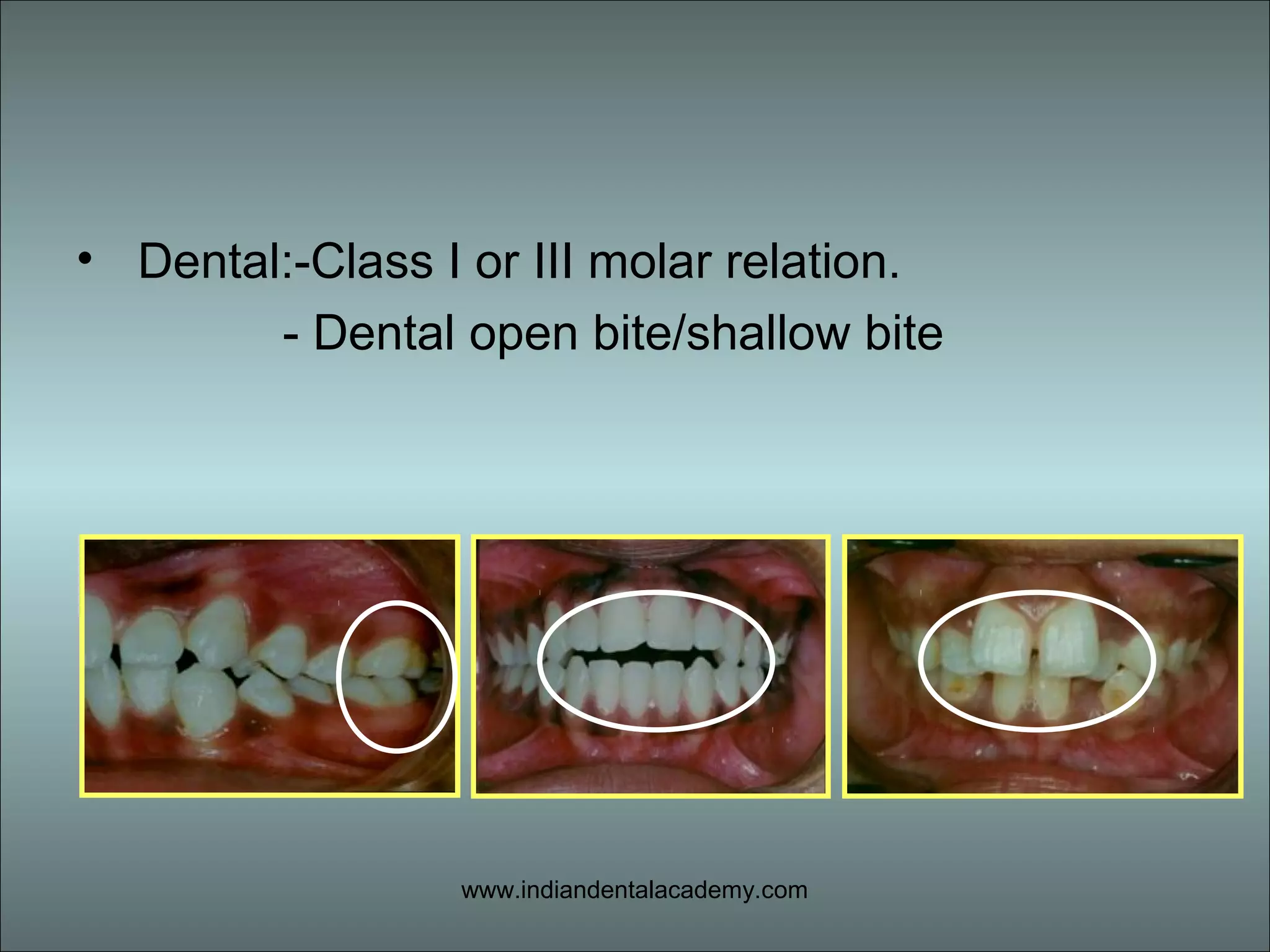 Biomechanics of molar distalization | PPT