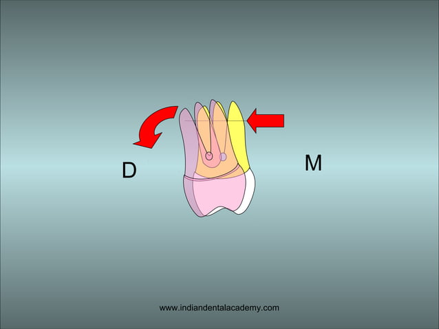 Biomechanics of molar distalization | PPT