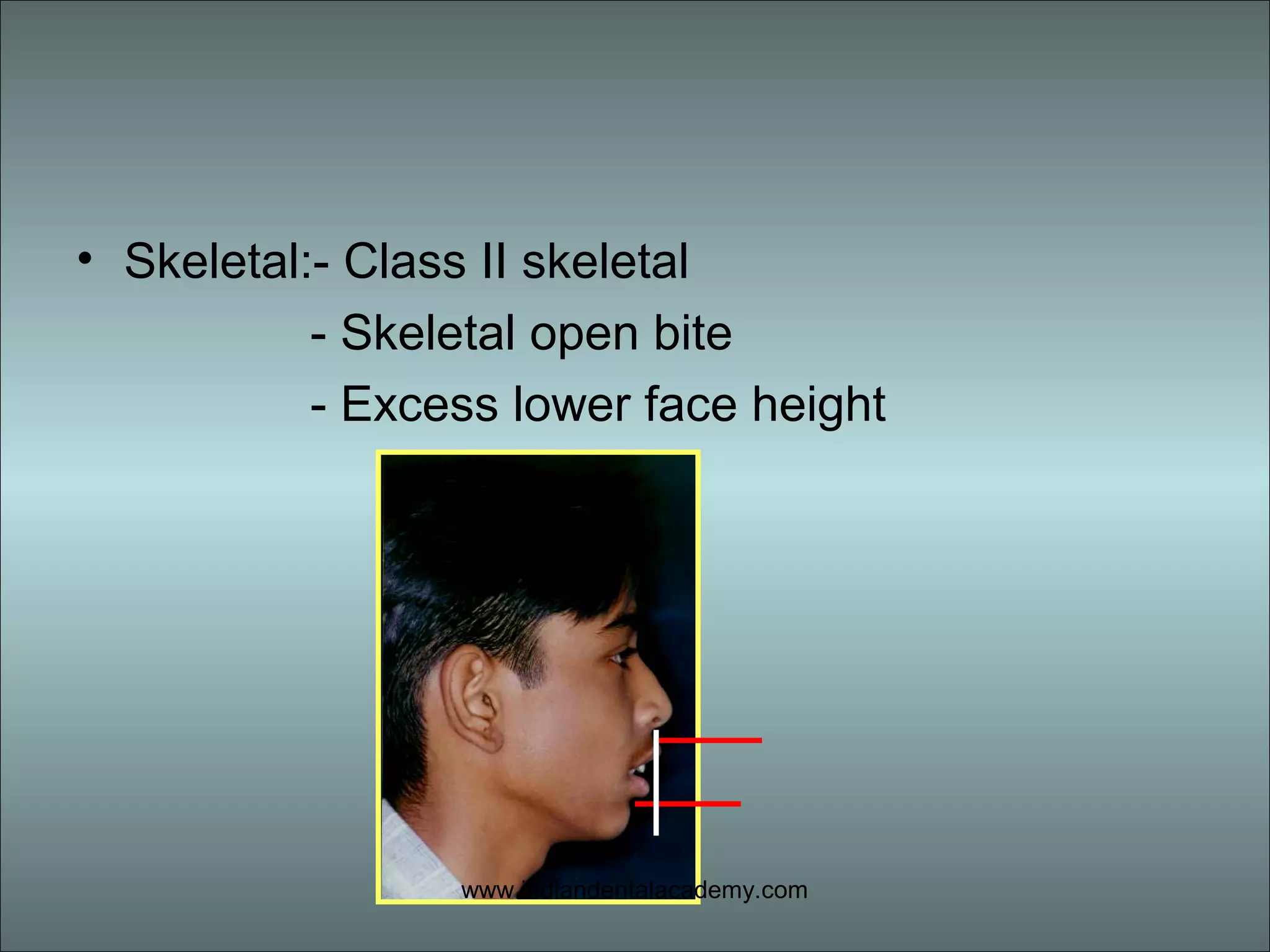 Biomechanics of molar distalization | PPT | Dental Health | Diseases ...