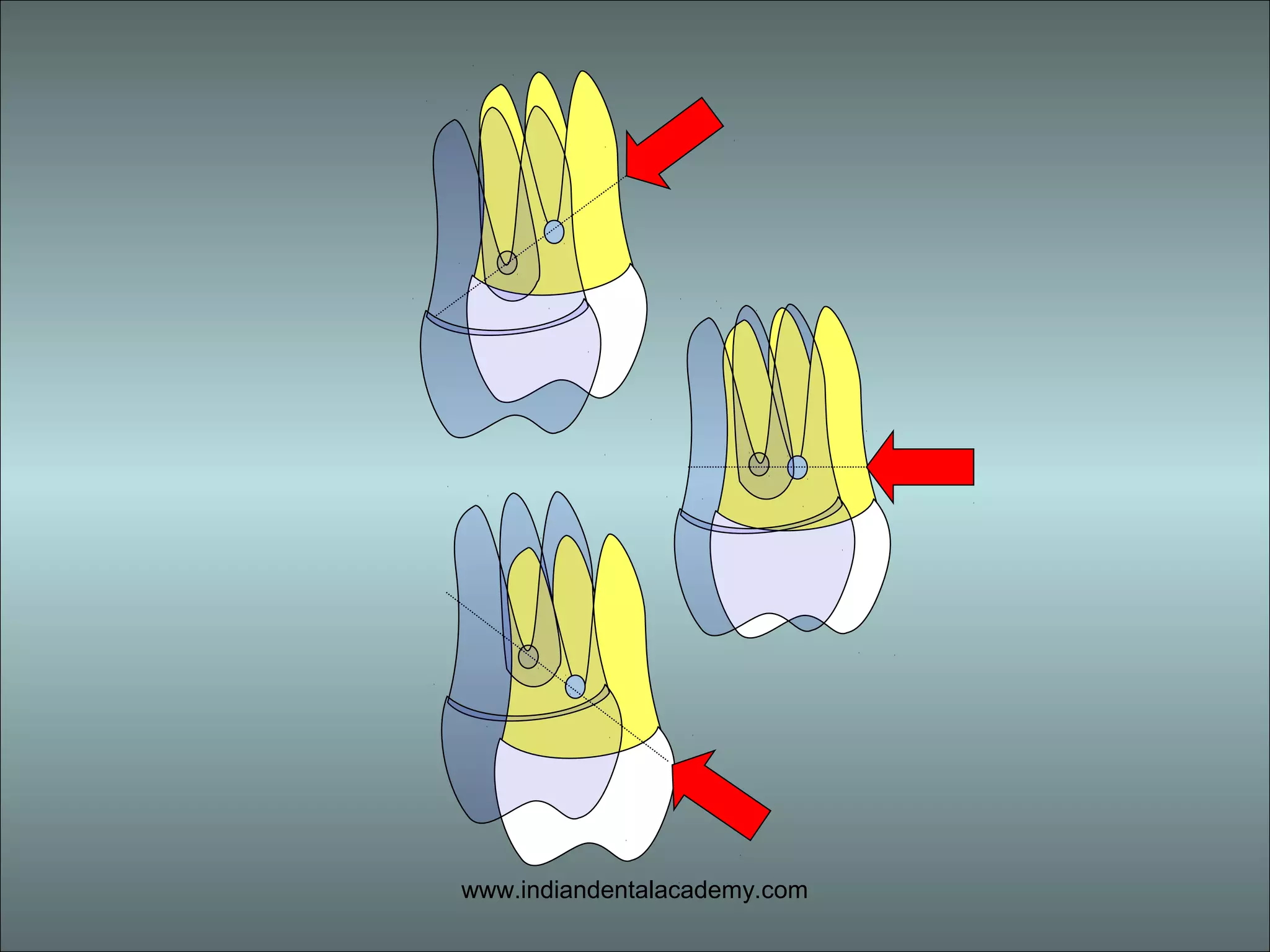 Biomechanics of molar distalization | PPT | Dental Health | Diseases ...
