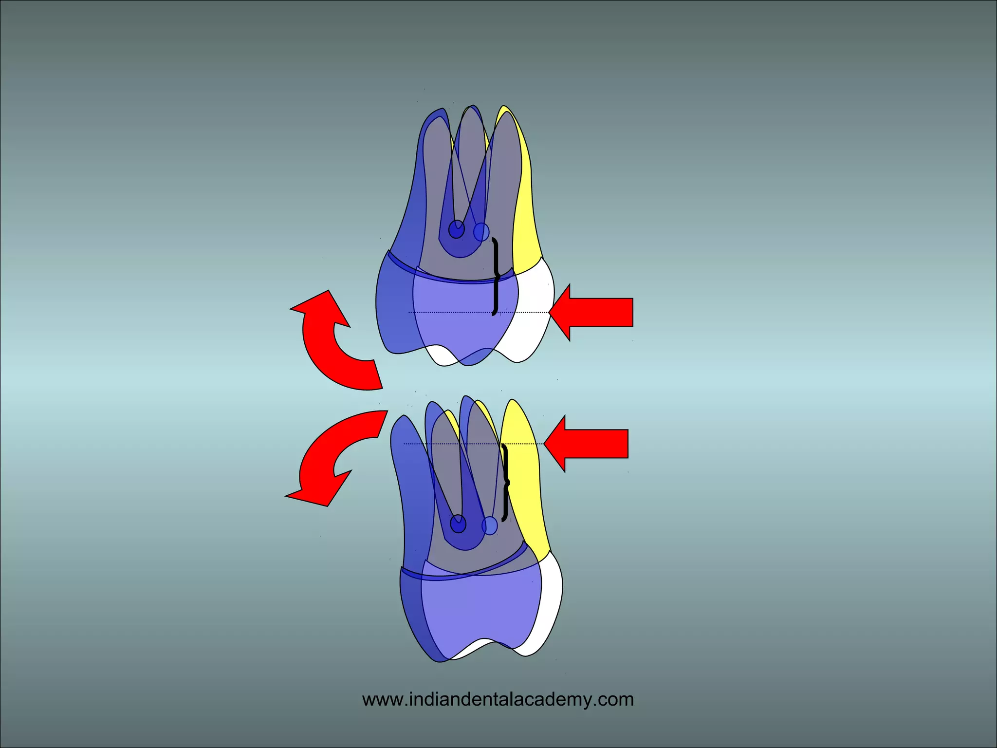 Biomechanics of molar distalization | PPT | Dental Health | Diseases ...