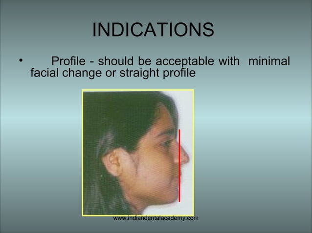 Biomechanics of molar distalization | PPT | Dental Health | Diseases ...