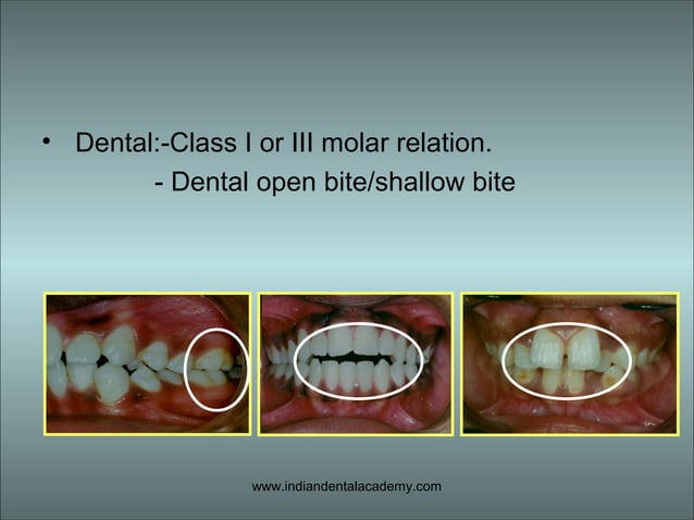 Biomechanics of molar distalization | PPT | Dental Health | Diseases ...