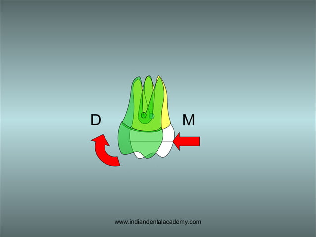 Biomechanics of molar distalization | PPT | Dental Health | Diseases ...