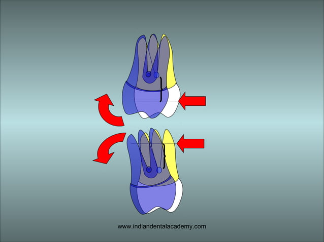 Biomechanics of molar distalization | PPT | Dental Health | Diseases ...