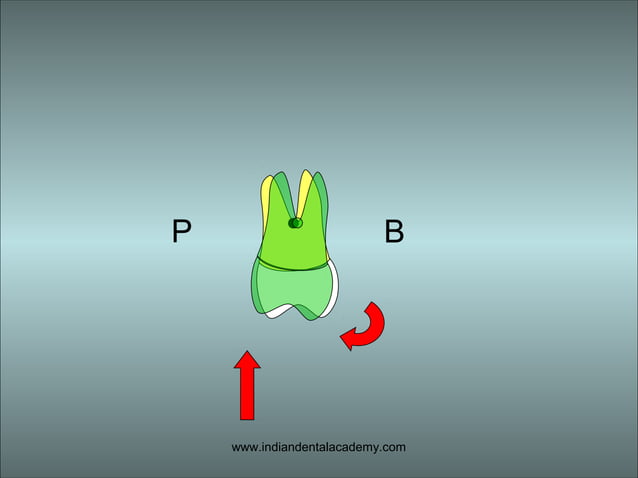 Biomechanics of molar distalization | PPT | Dental Health | Diseases ...