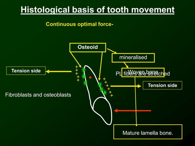 Biomechanics of Orthodontic Tooth Movement _2 - Dr. Nabil Al-Zubair ...