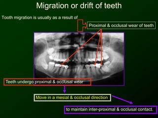 Biomechanics of Orthodontic Tooth Movement _2 - Dr. Nabil Al-Zubair | PPTX