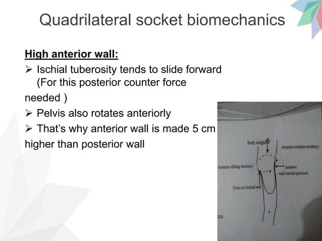Biomechanics of Quadrilateral socket | PPTX