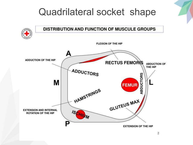 Biomechanics of Quadrilateral socket