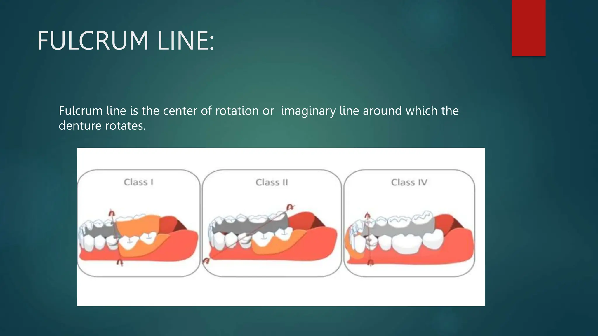BIOMECHANICS OF REMOVABLE PARTIAL DENTURE new.pptx