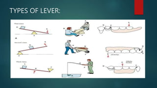 BIOMECHANICS OF REMOVABLE PARTIAL DENTURE new.pptx | Dental Health ...