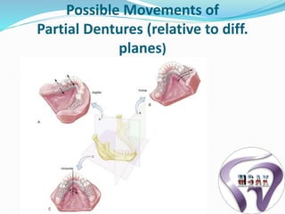 Biomechanics of rpd | PPTX