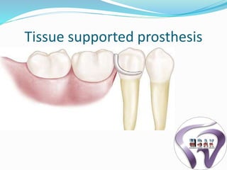 Biomechanics of rpd | PPTX