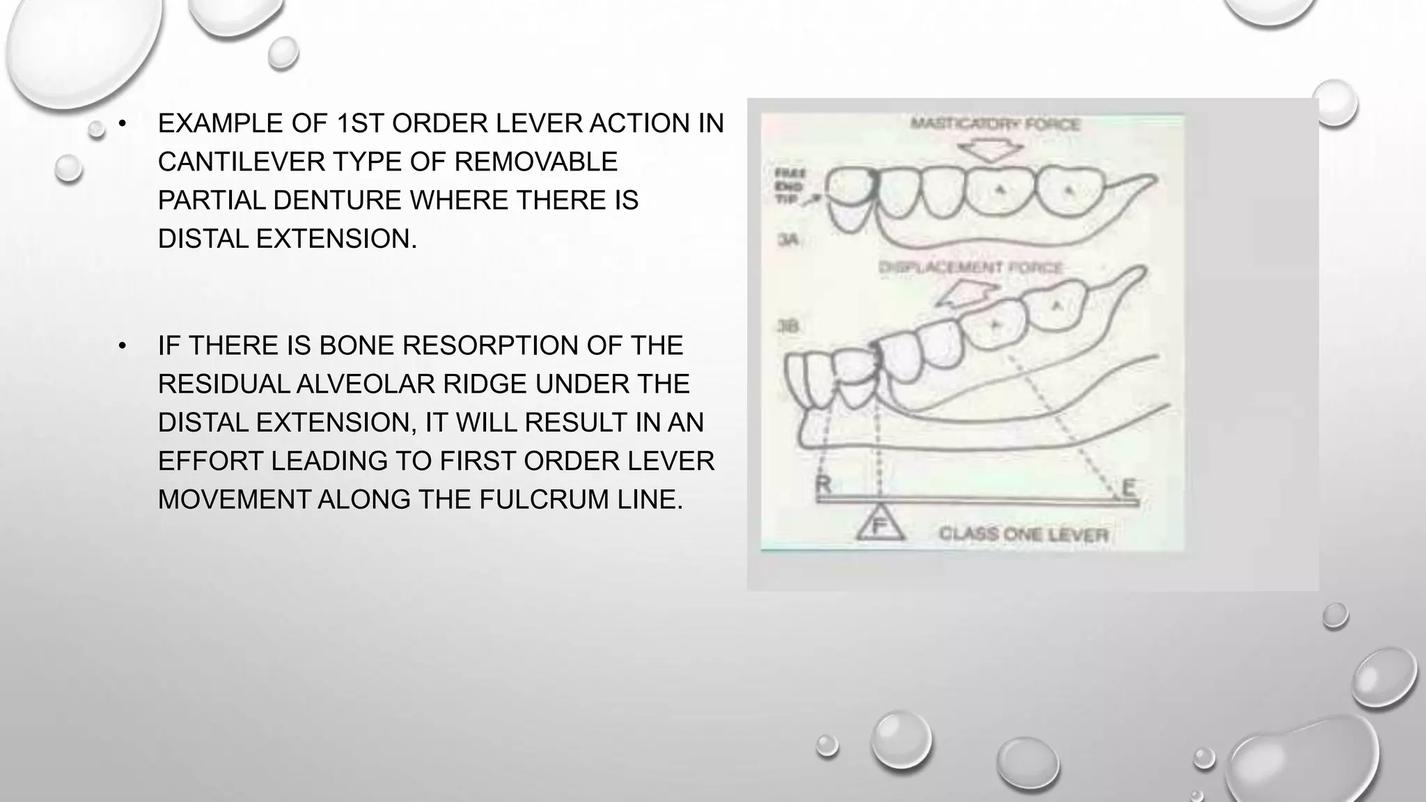 Biomechanics of RPD | PPTX