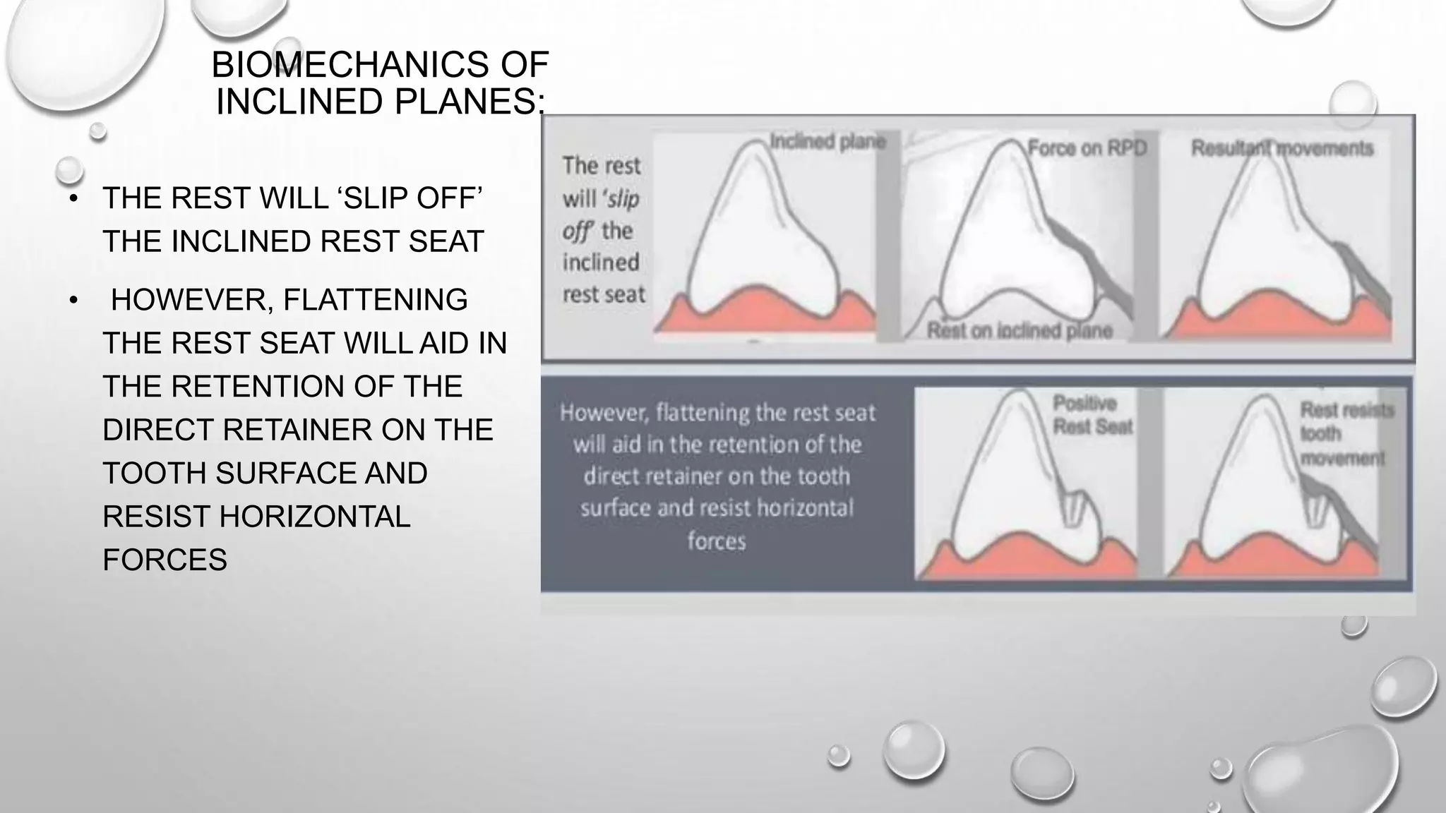 Biomechanics of RPD | PPTX