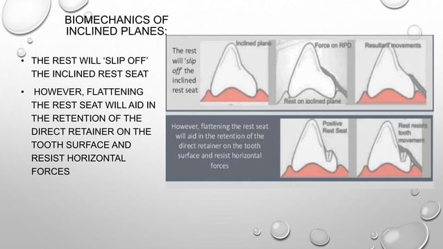Biomechanics of RPD | PPTX | Oral care | Personal Care