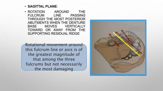 Biomechanics of RPD | PPTX | Oral care | Personal Care