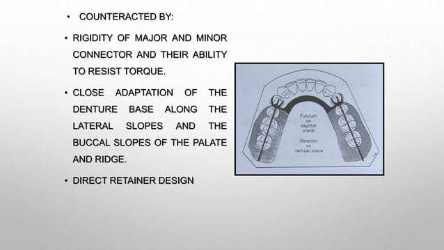 Biomechanics of RPD | PPTX | Oral care | Personal Care