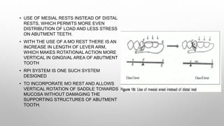 Biomechanics of RPD | PPTX