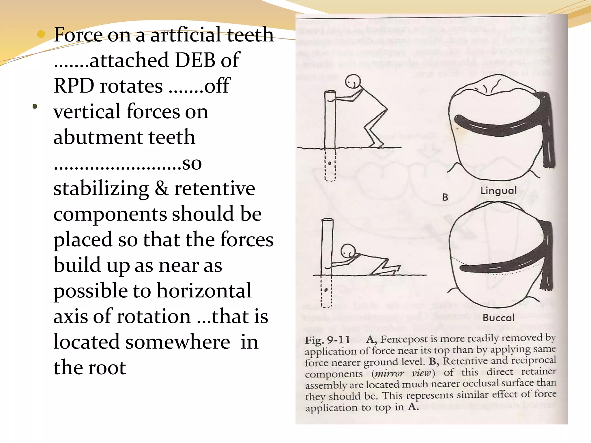 Biomechanics of RPD | PPTX