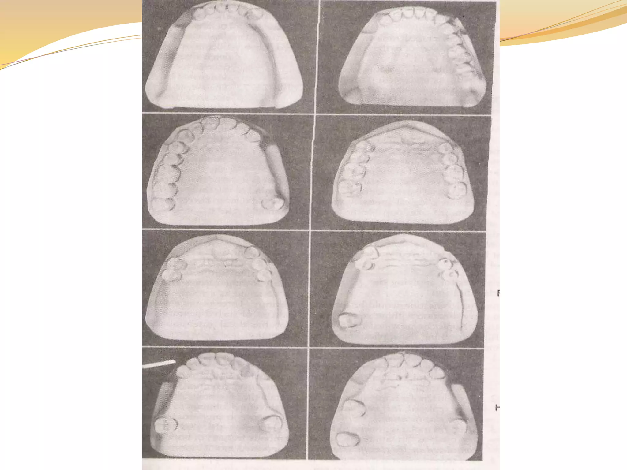 Biomechanics of RPD | PPTX