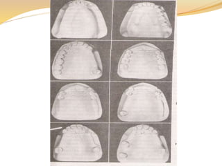 Biomechanics of RPD | PPTX