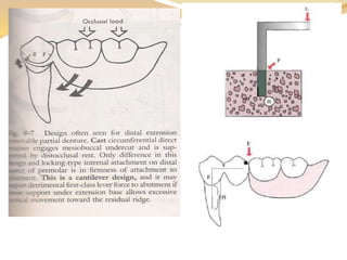 Biomechanics of RPD | PPT