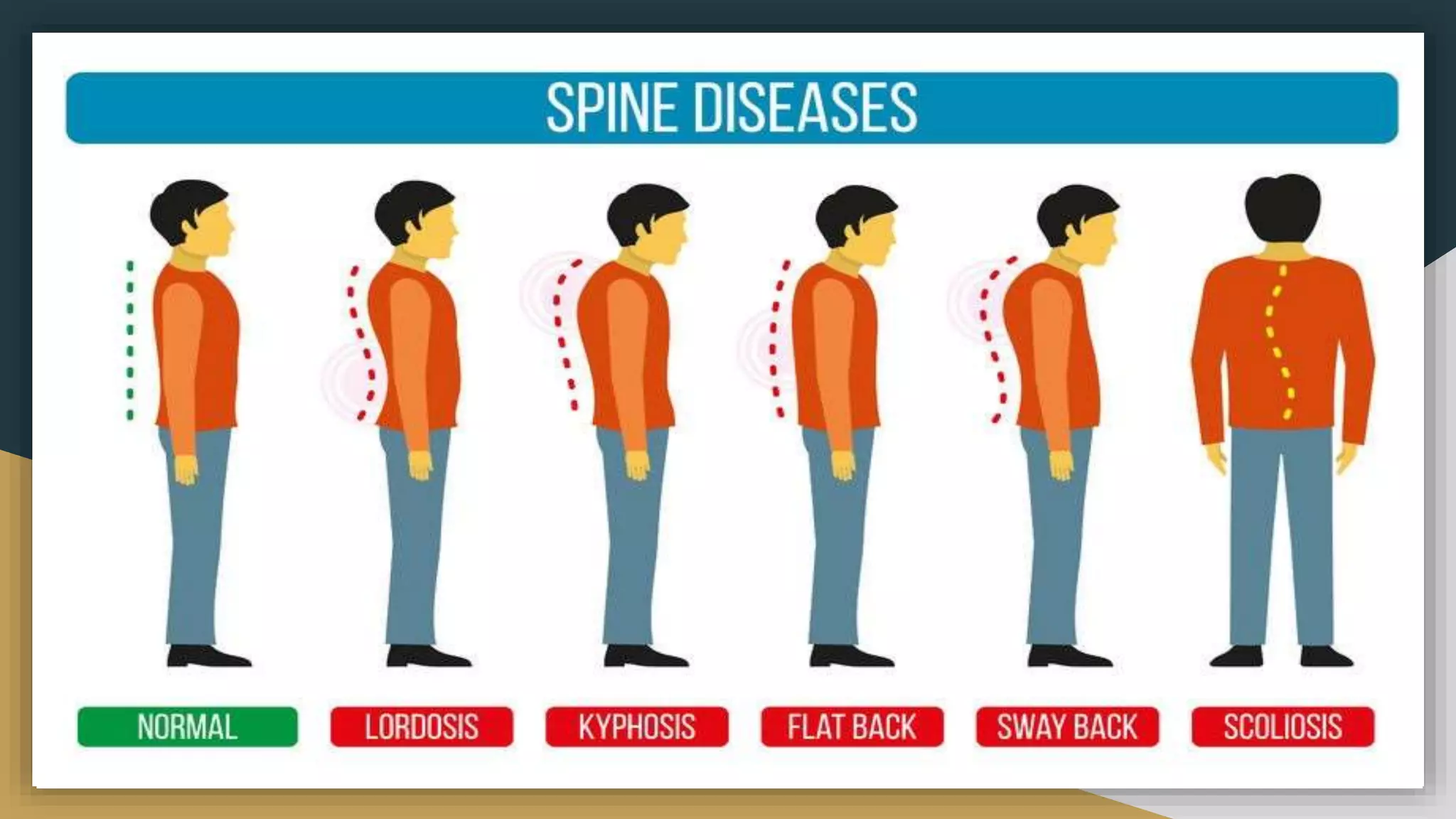 Biomechanics of spinal orthotics (MD.Nayeem hasan) | PPTX