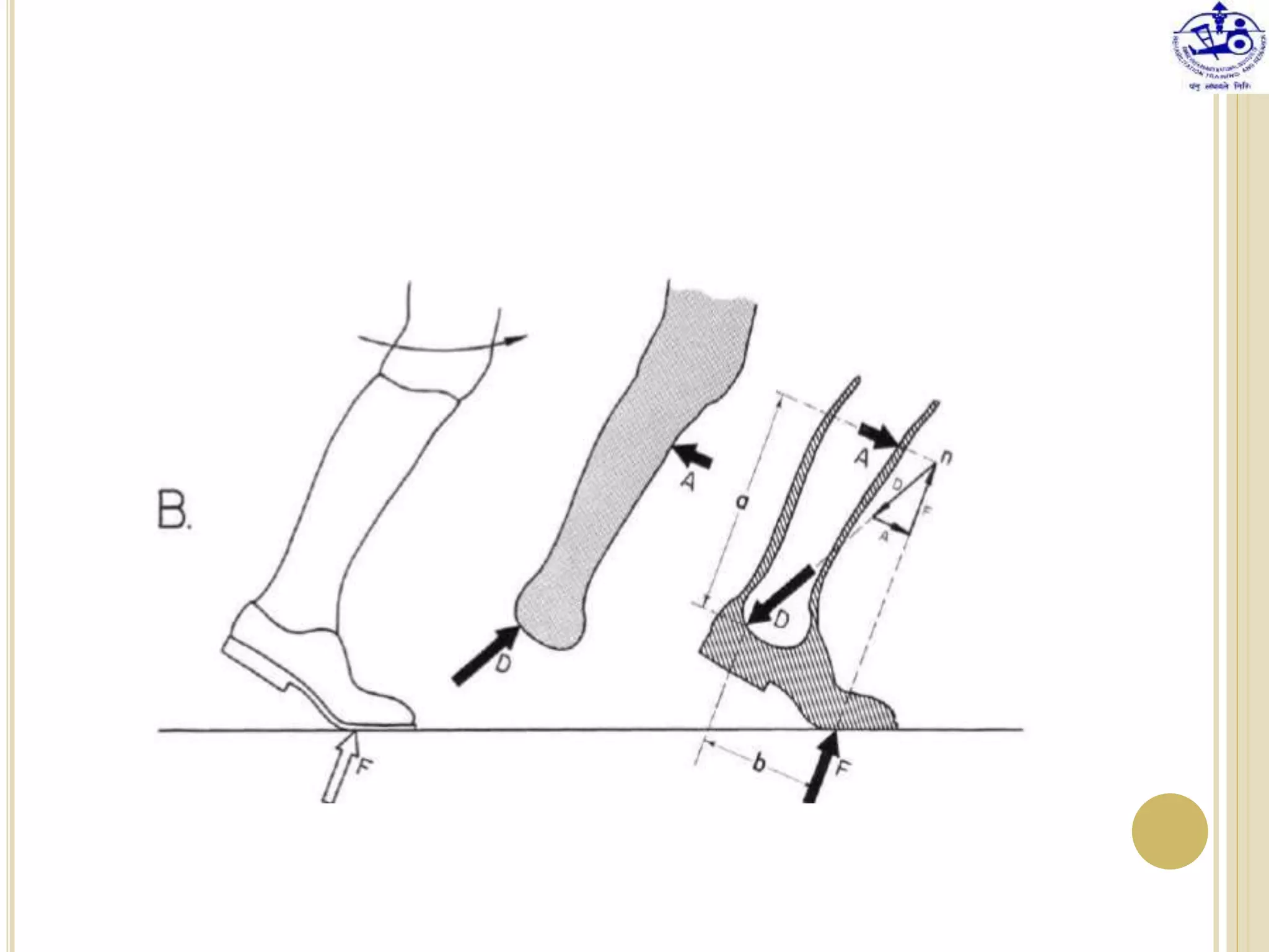 Biomechanics of symes prosthesis.pptx