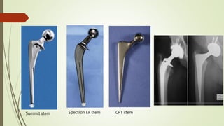 Biomechanics of THA AIIMS JODHPUR SEMINAR | PPTX