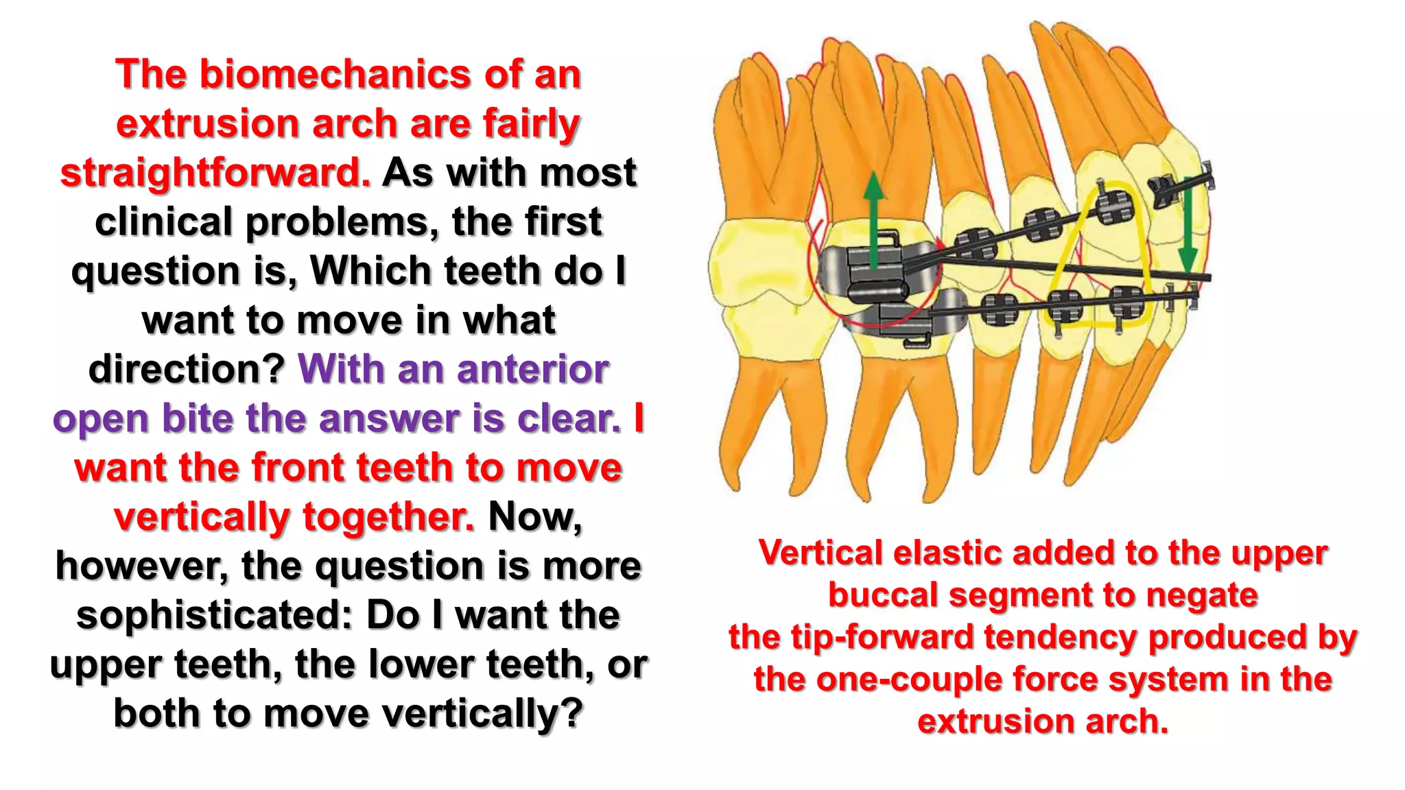 Biomechanics of the extrusion arches | PPTX