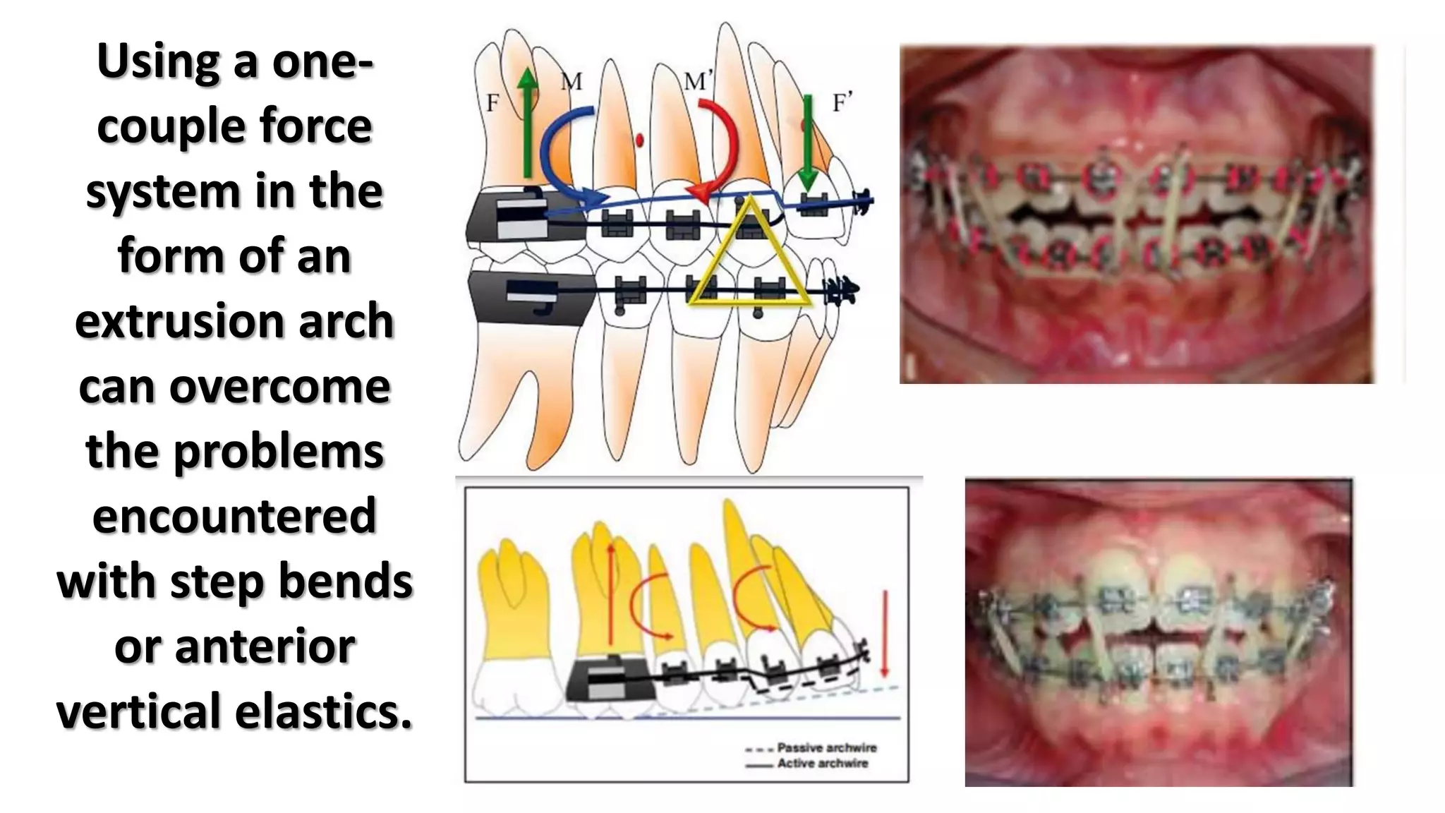 Biomechanics of the extrusion arches | PPTX
