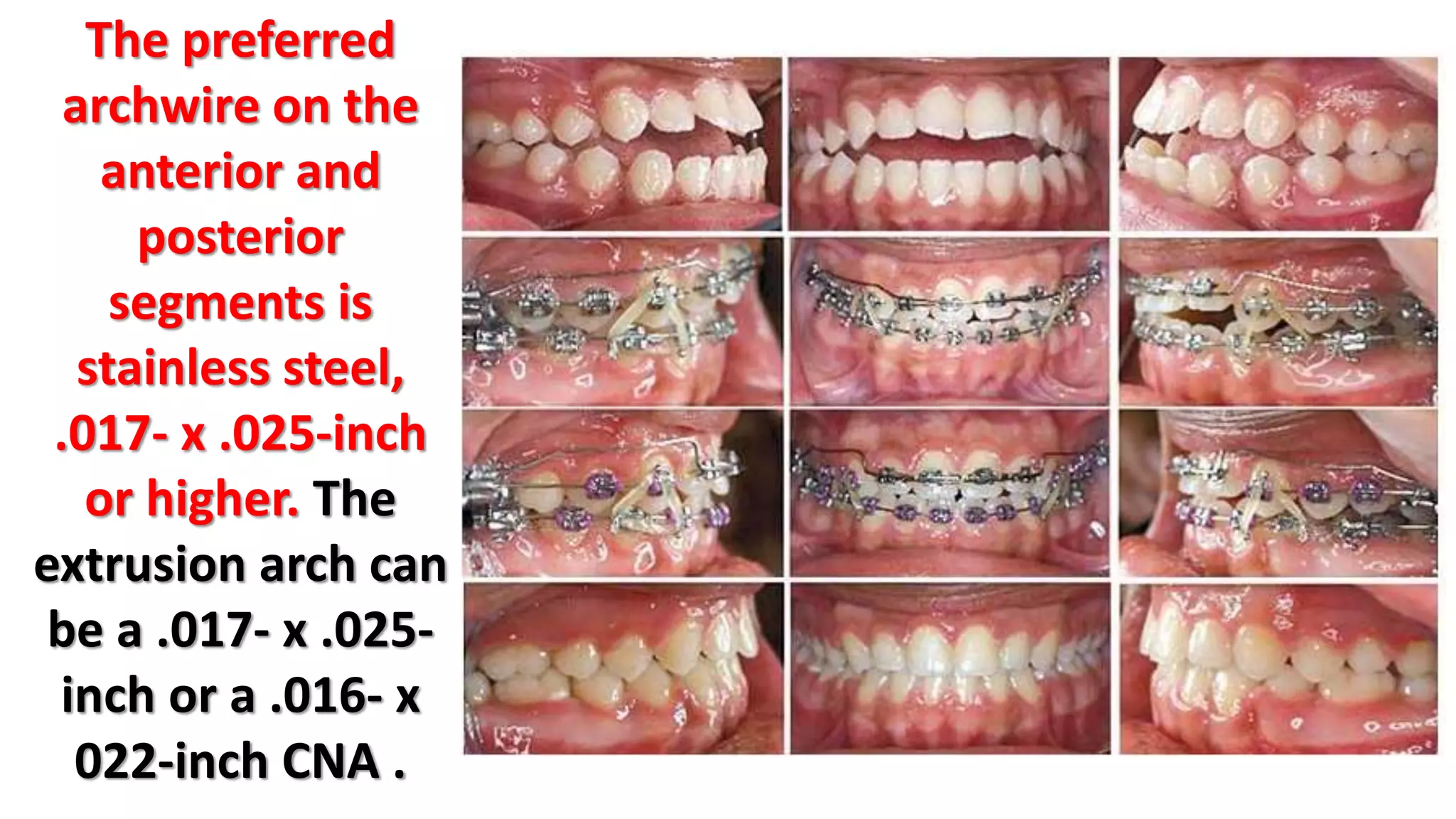 Biomechanics of the extrusion arches | PPTX