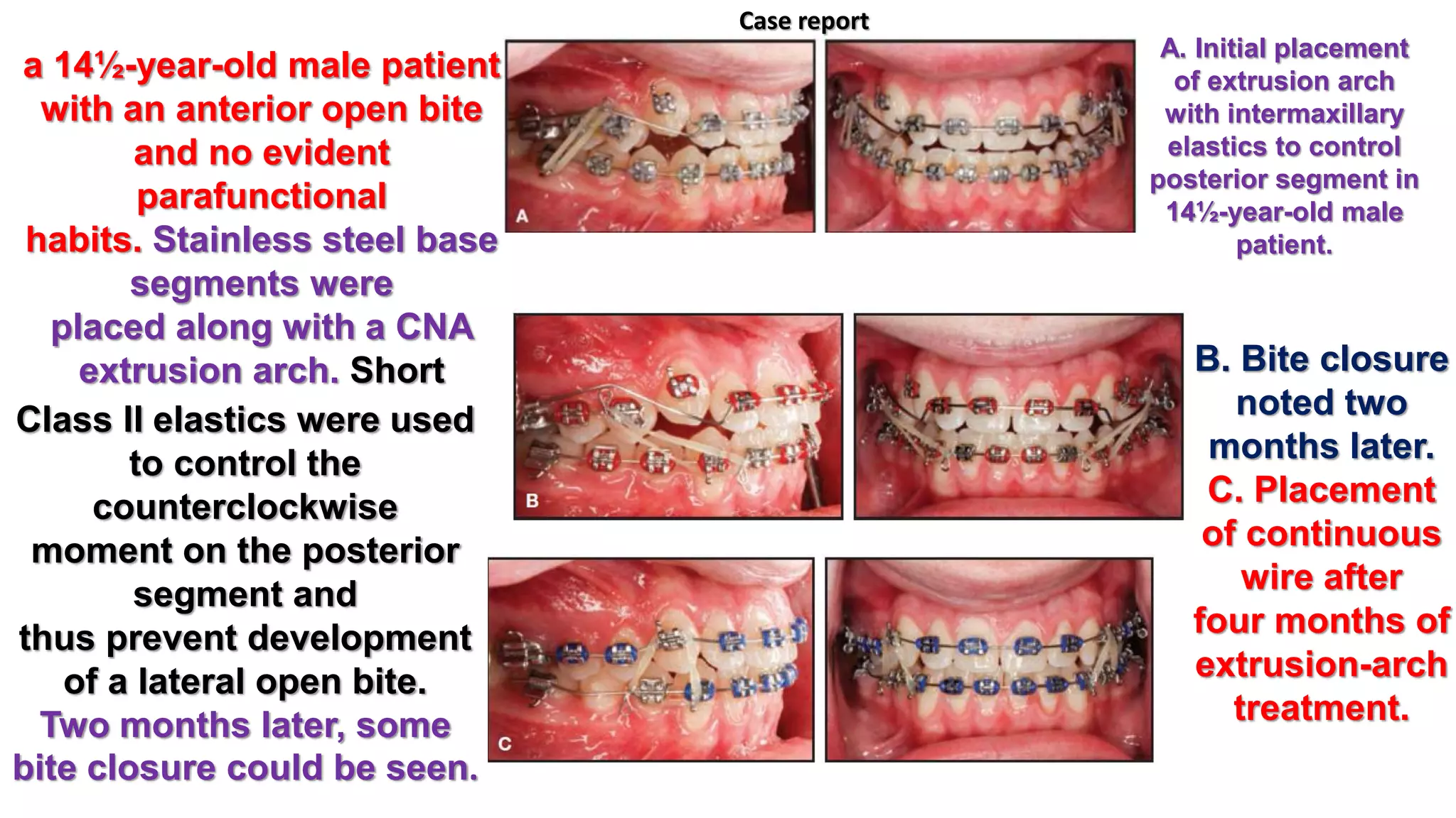 Biomechanics of the extrusion arches | PPTX
