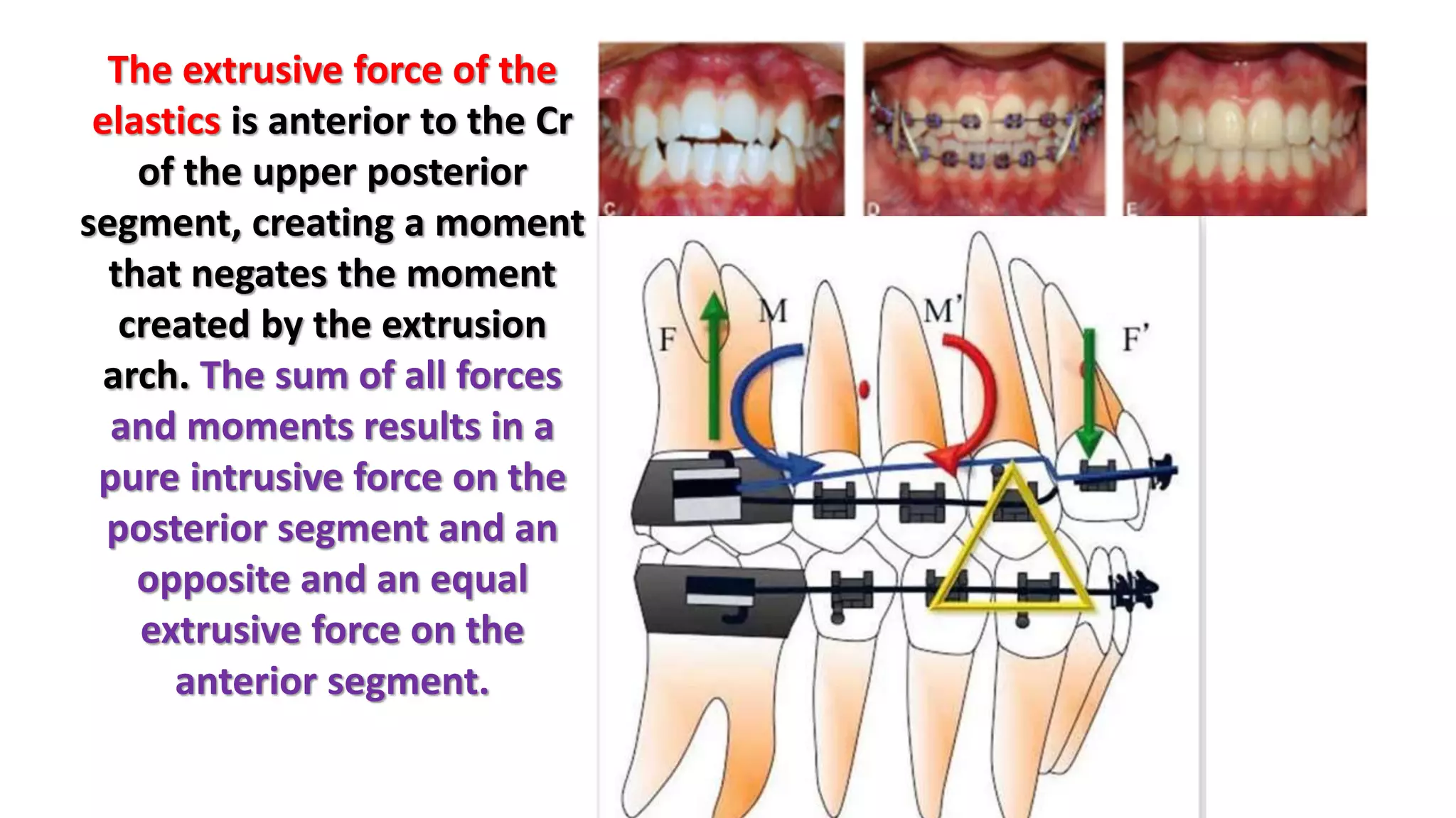 Biomechanics of the extrusion arches | PPTX