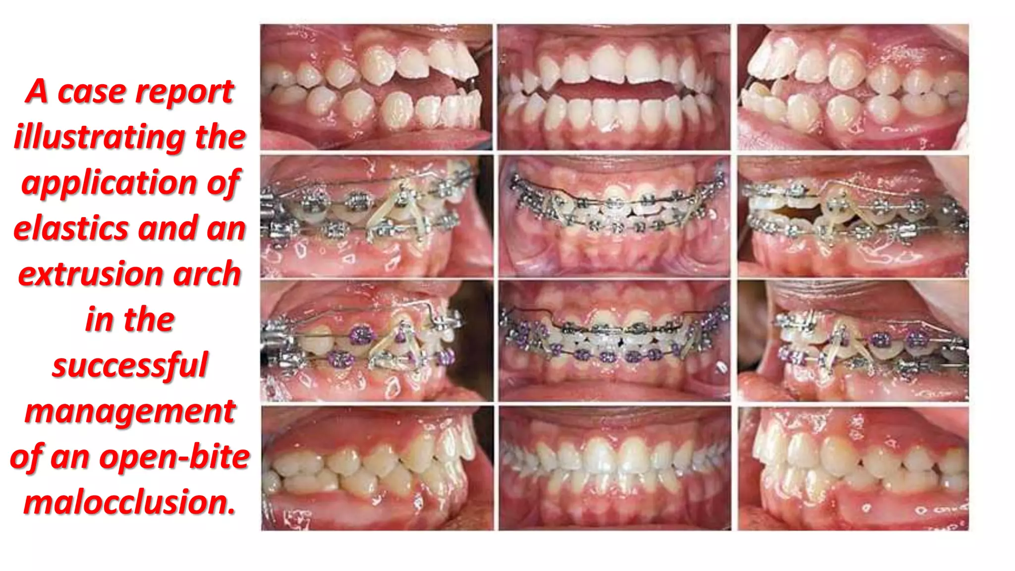 Biomechanics of the extrusion arches | PPTX