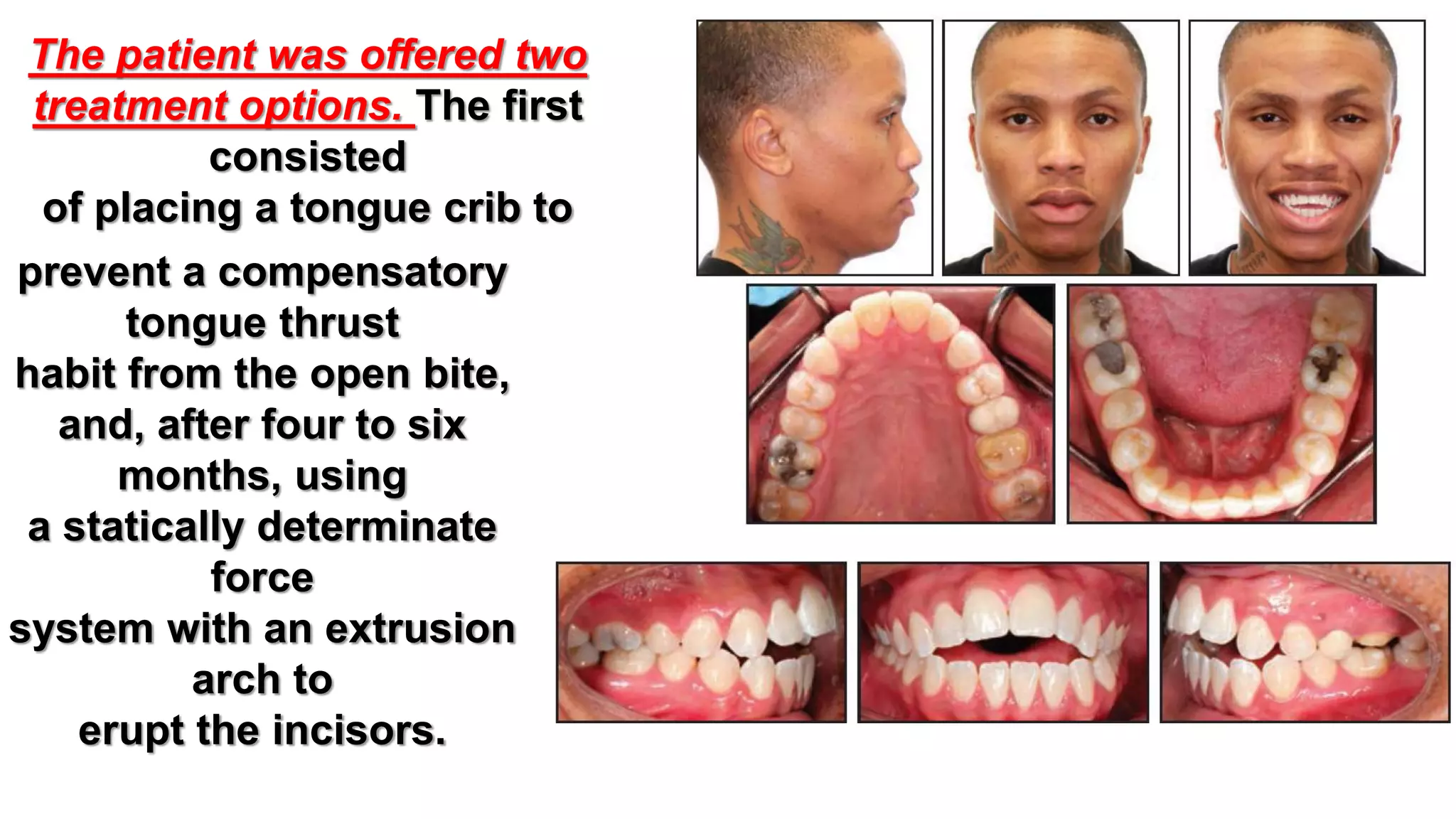 Biomechanics of the extrusion arches | PPTX